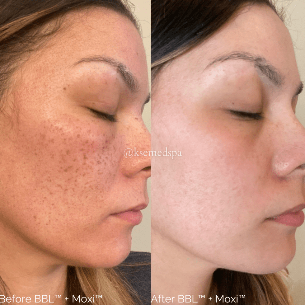 BBL & Moxi – Total Skin Rejuvenation | Kingwood Skin Essentials